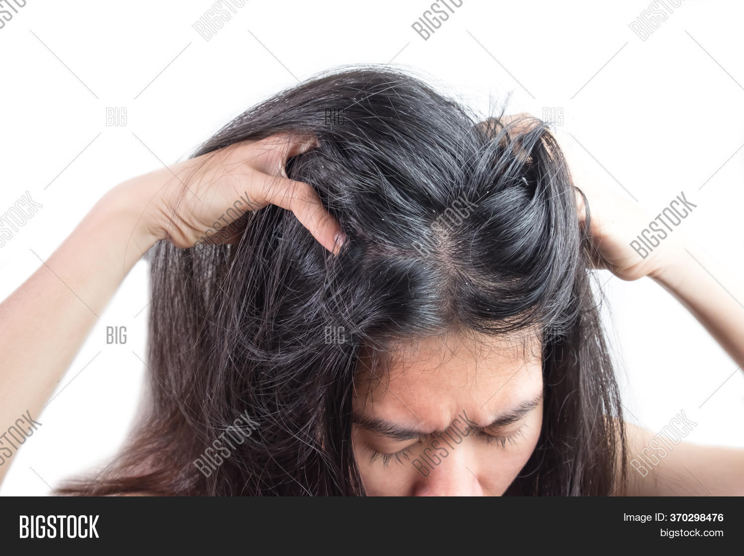 Women Head Dandruff Image & Photo (Free Trial) | Bigstock