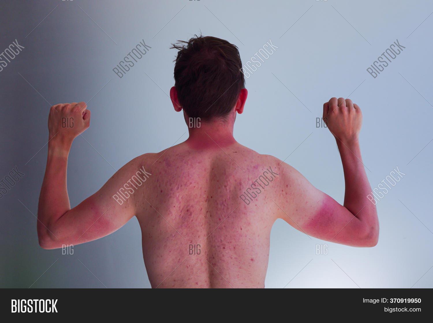 Guy Burned Sun City, Image & Photo (Free Trial) | Bigstock