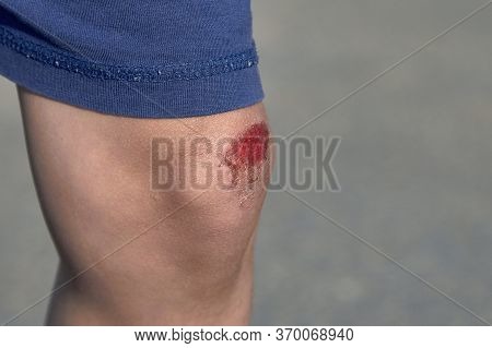 Bruised Wound On Knee Image & Photo (Free Trial) | Bigstock