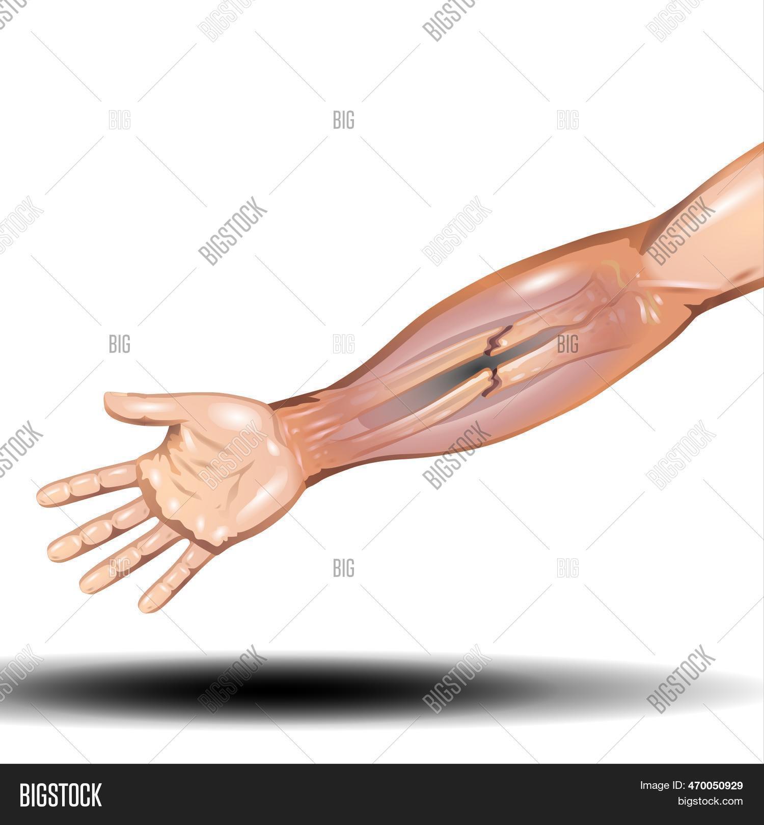 Hand Bone Fracture - Image & Photo (Free Trial) | Bigstock