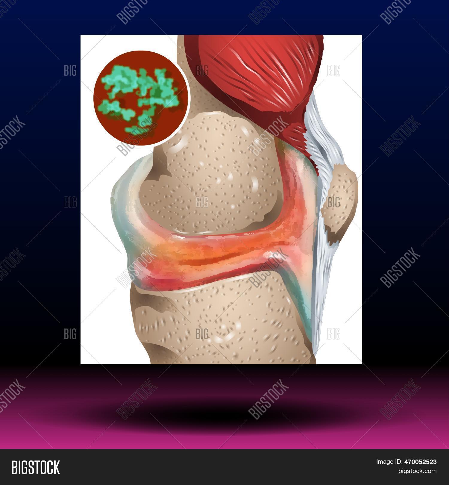 Septic Arthritis - Image & Photo (Free Trial) | Bigstock
