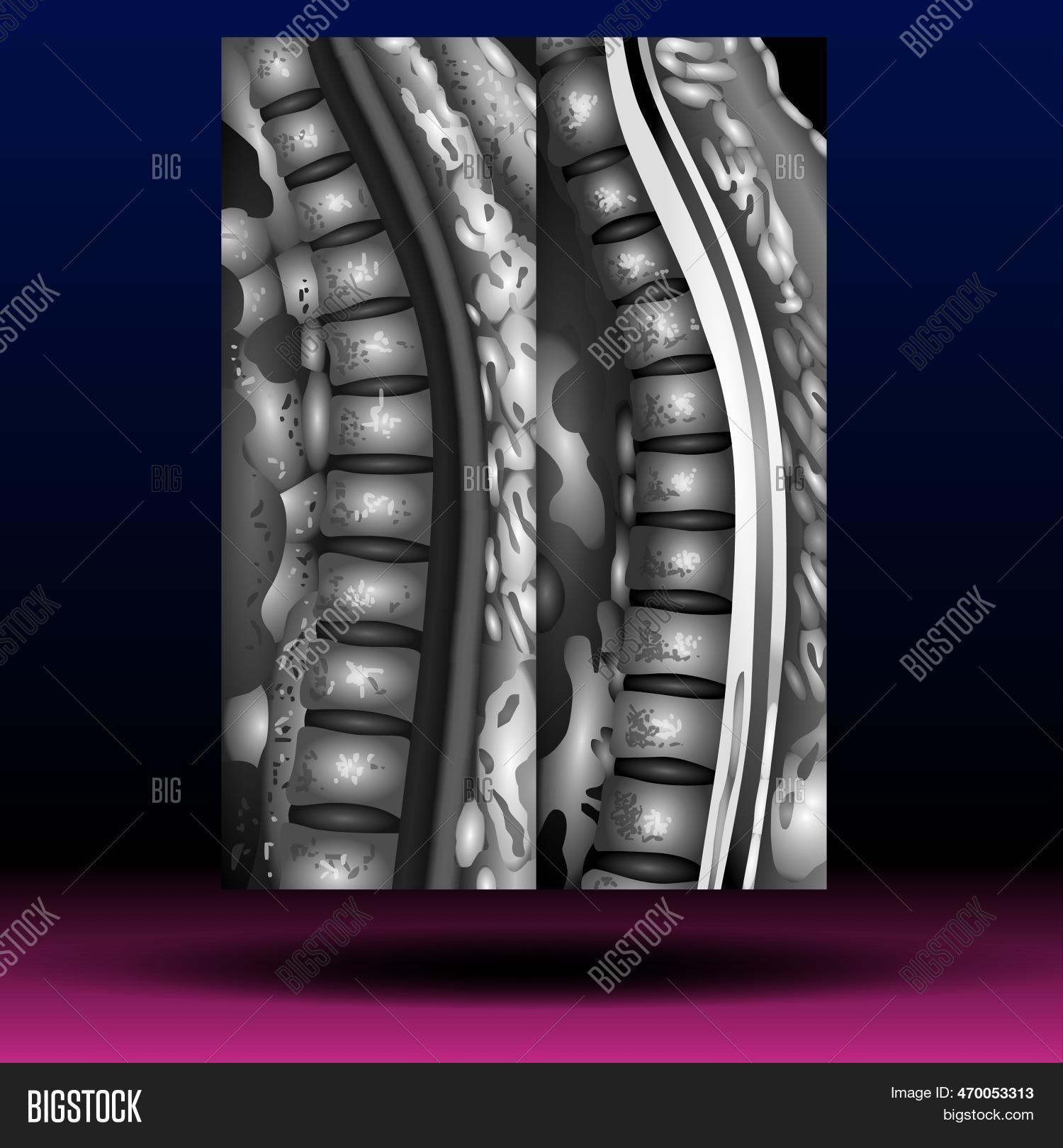 X-ray Myelography - Image & Photo (Free Trial) | Bigstock