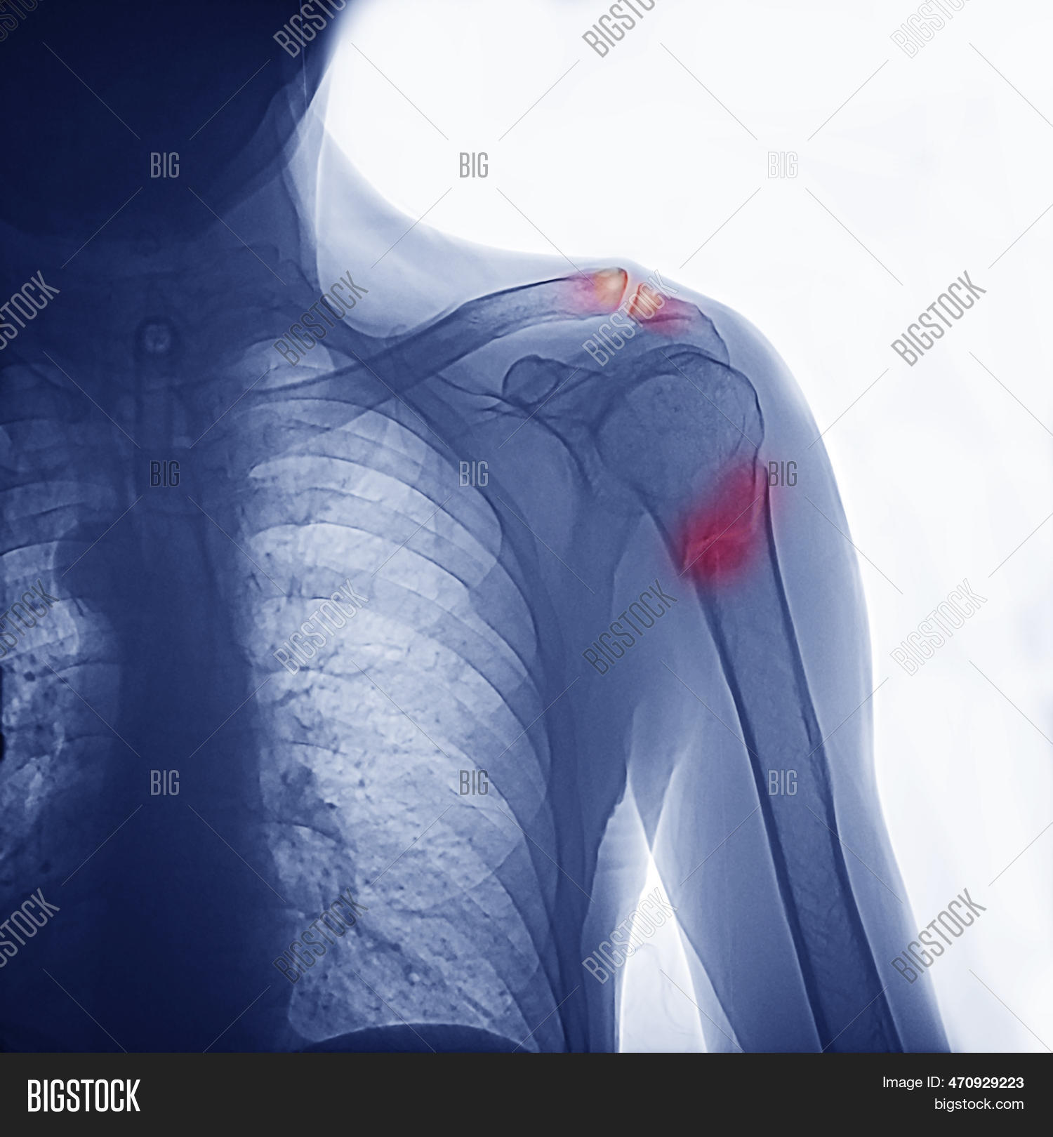 X-ray Human Shoulder Image & Photo (Free Trial) | Bigstock