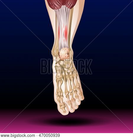 Human Front Leg Bone Image & Photo (Free Trial) | Bigstock