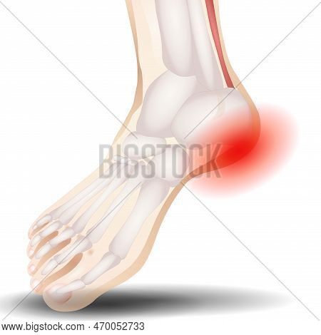 Toe Bone On 이미지 및 사진(무료 체험) | Bigstock