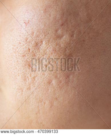 Imagen y foto Teenage Girl Acne (prueba gratis) | Bigstock