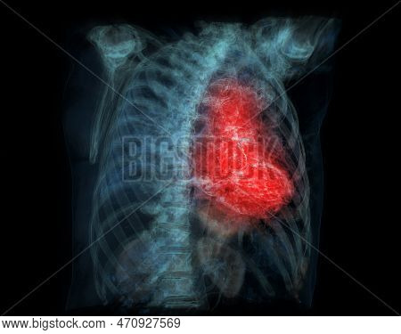 Human Heart Attack Image & Photo (Free Trial) | Bigstock