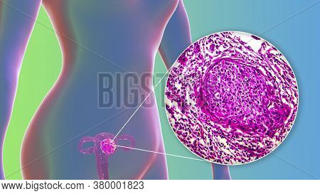Uterine Cancer, 3d Image & Photo (Free Trial) | Bigstock