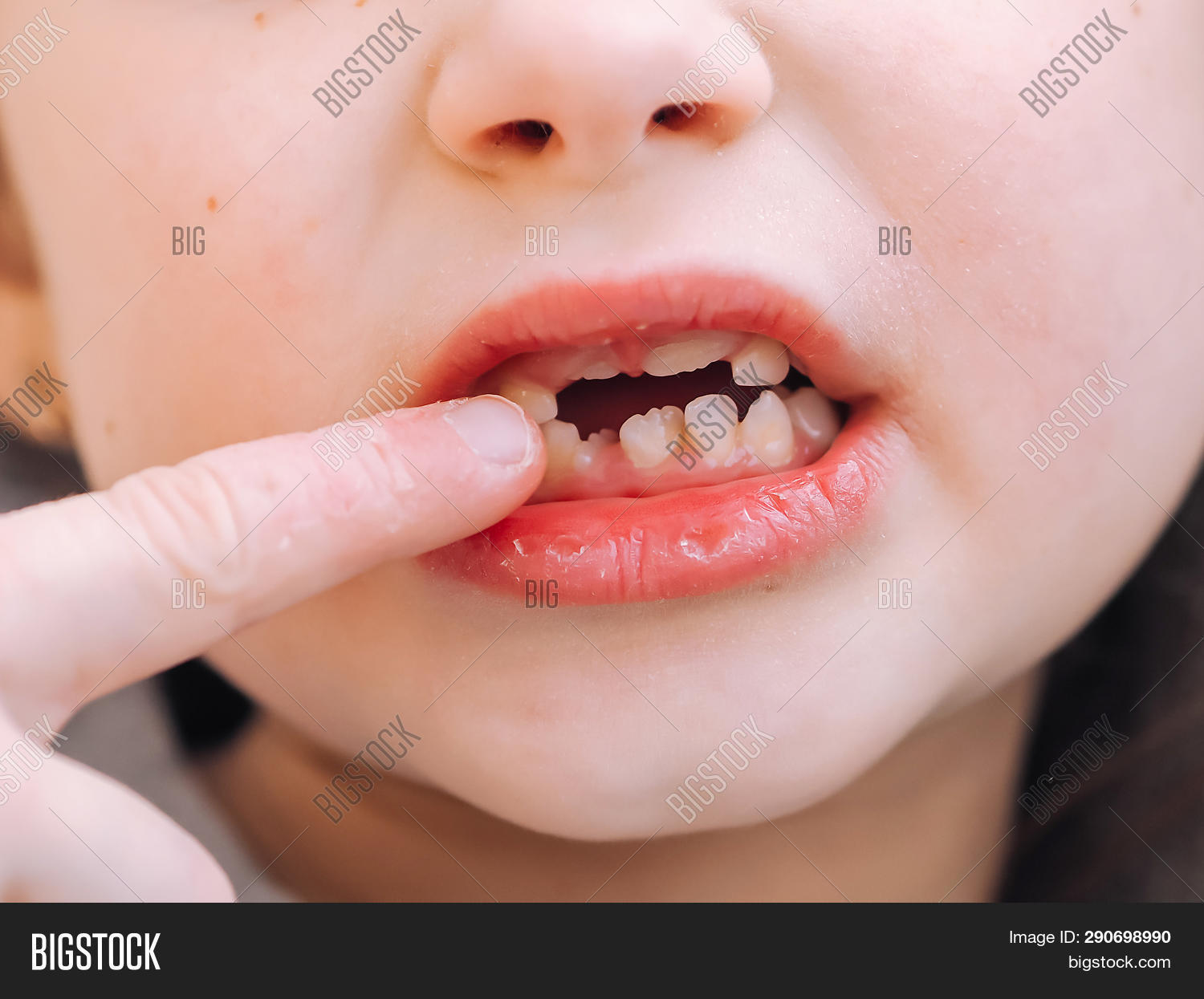 Child Has Milk Tooth Image & Photo (Free Trial) | Bigstock