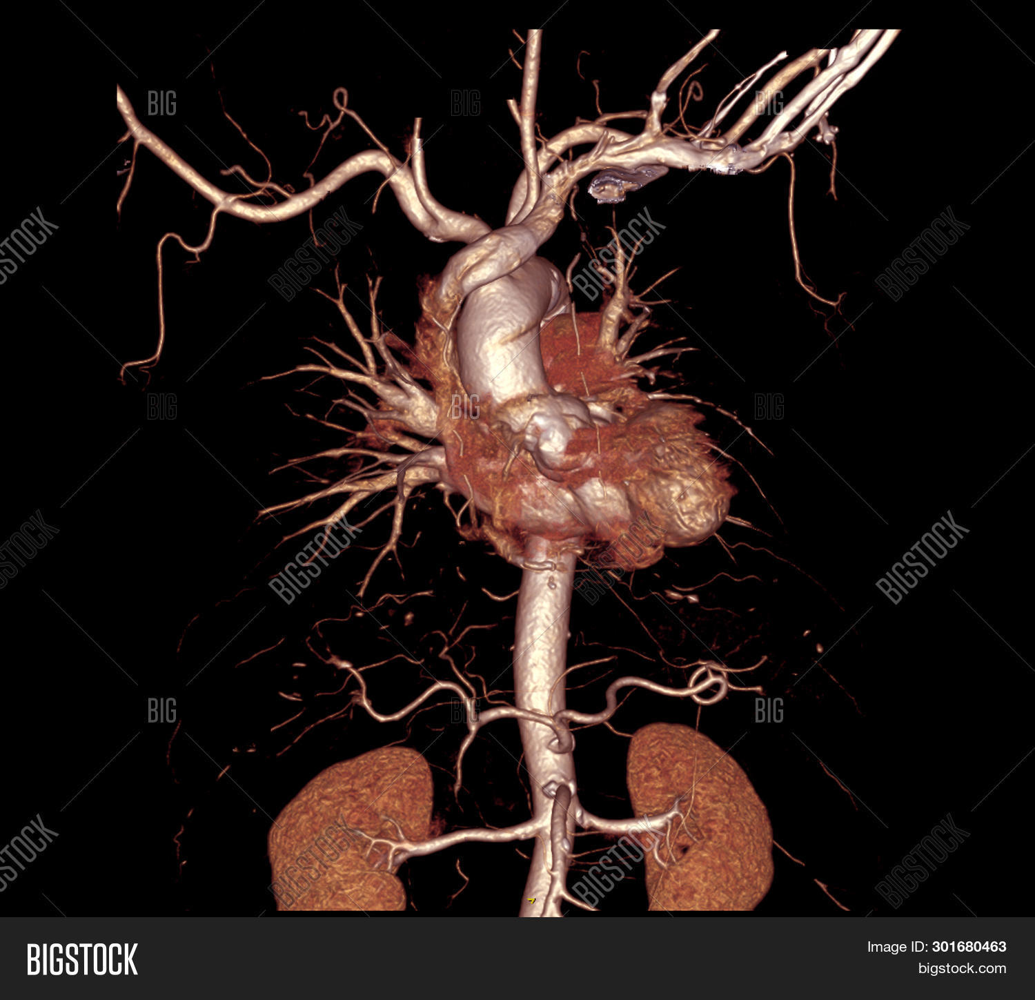 Cta Thoracic Aorta 3d Image & Photo (Free Trial) | Bigstock