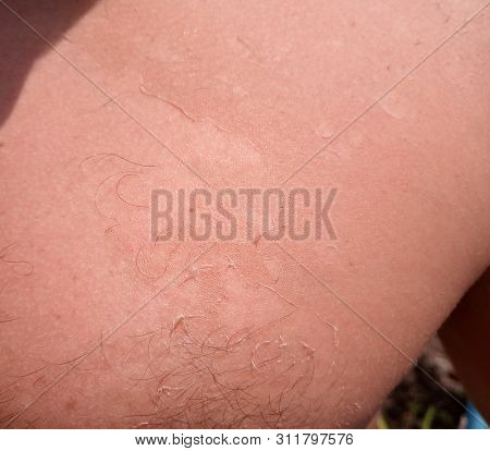 Exfoliation Skin After Image & Photo (Free Trial) | Bigstock
