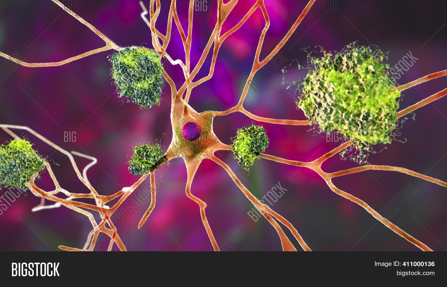Neurons Alzheimer's Image & Photo (Free Trial) | Bigstock