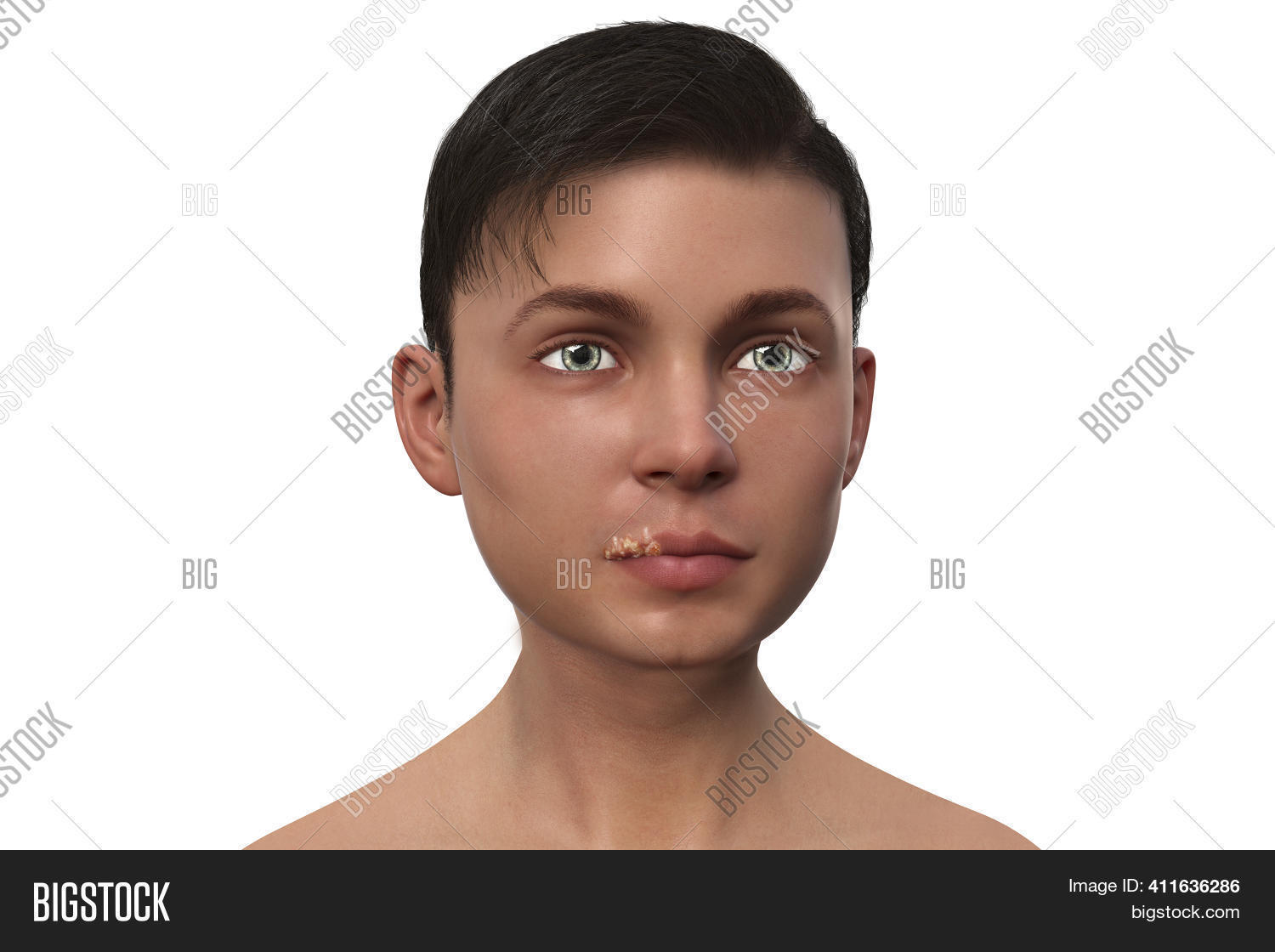 Herpes Labialis, Known Image & Photo (Free Trial) | Bigstock