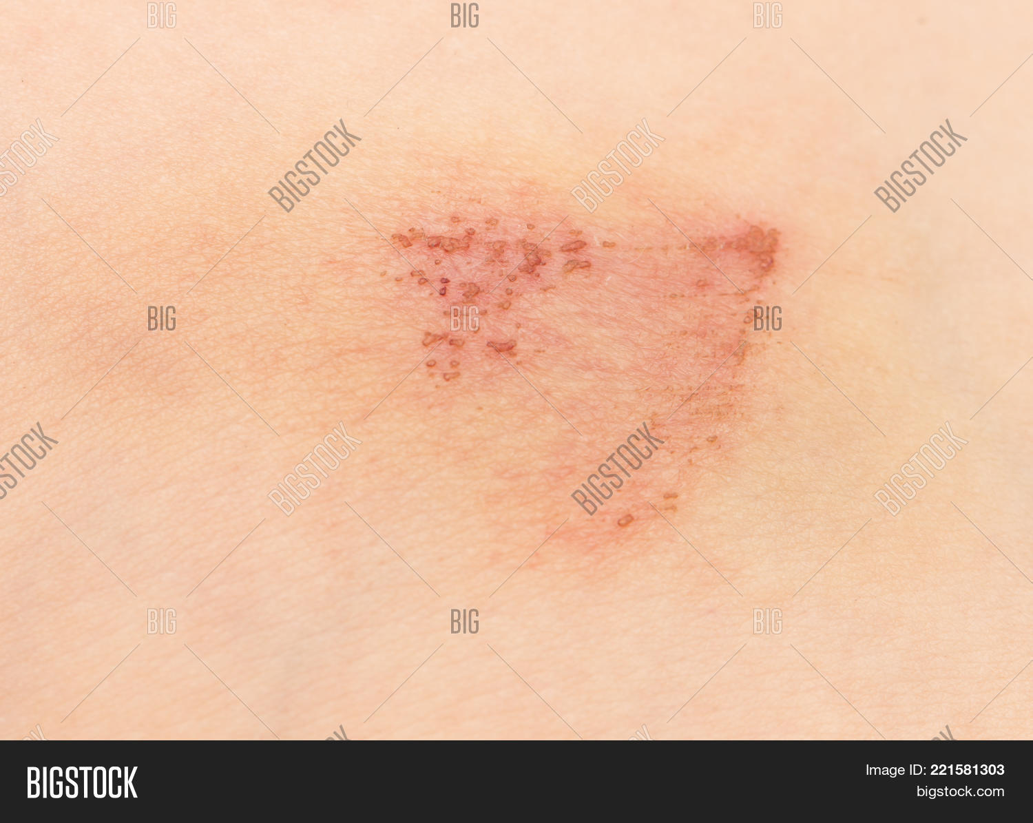 Wound Human Skin . Image & Photo (Free Trial) | Bigstock