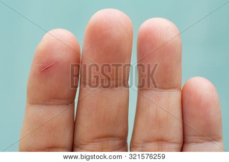 Woman Has Been Cut Image & Photo (Free Trial) | Bigstock