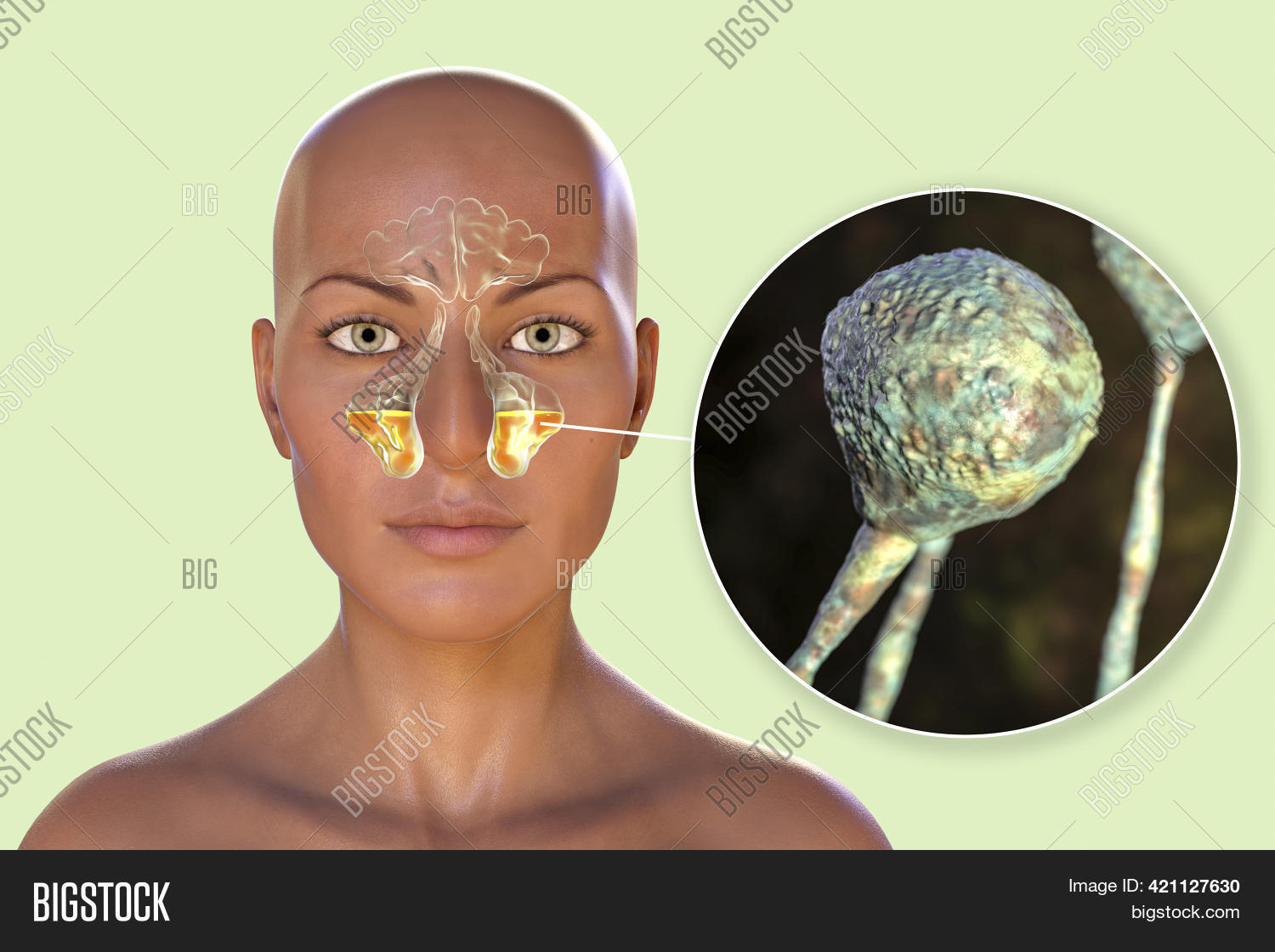 Mucor Fungi Cause Image & Photo (Free Trial) | Bigstock