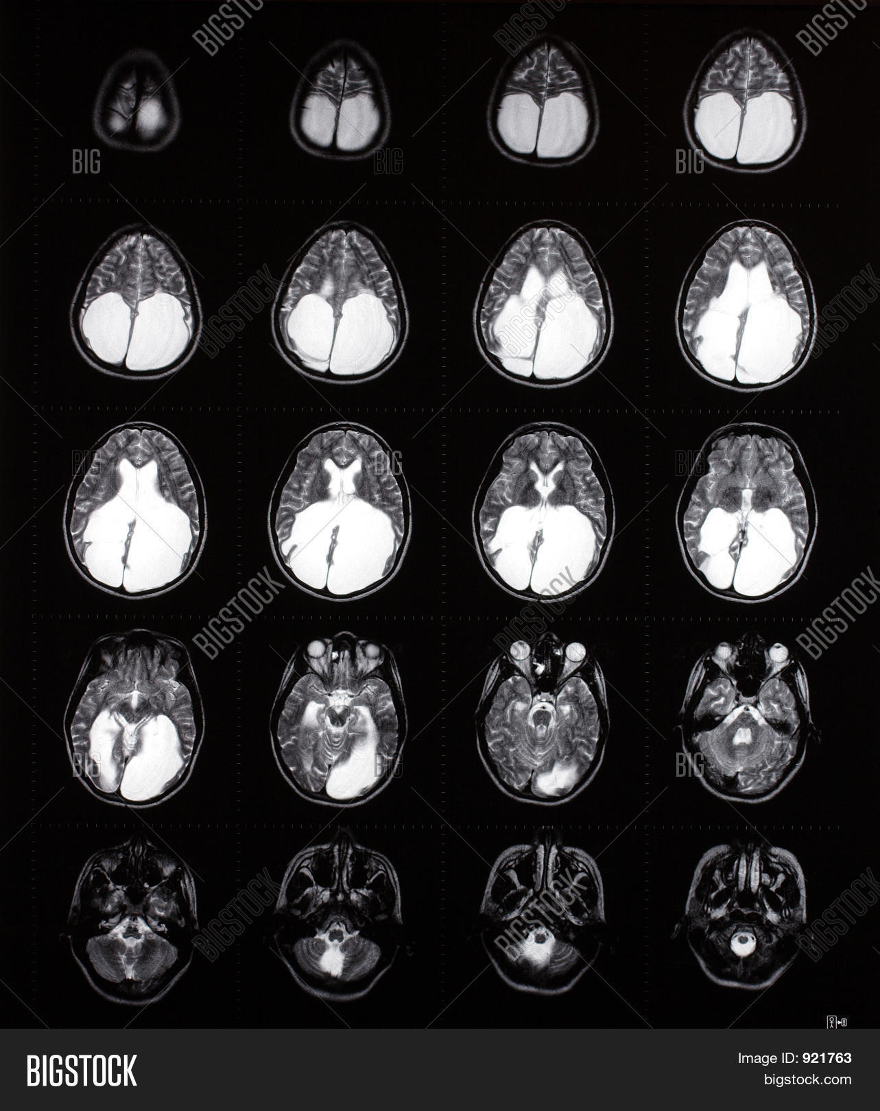 Brain Mri Showing Image & Photo (Free Trial) | Bigstock