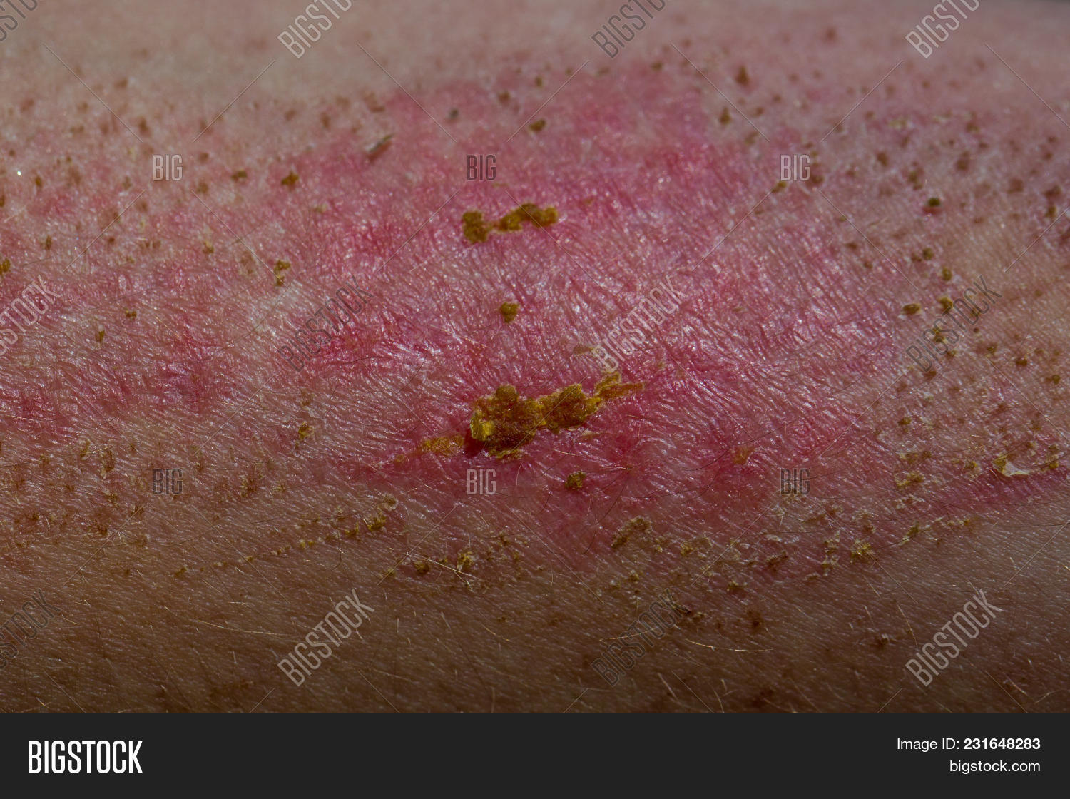 Skin Ailment Disease Image & Photo (Free Trial) | Bigstock