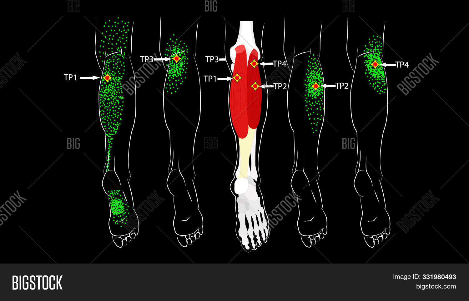 Calf Muscle. Trigger Image & Photo (Free Trial) | Bigstock