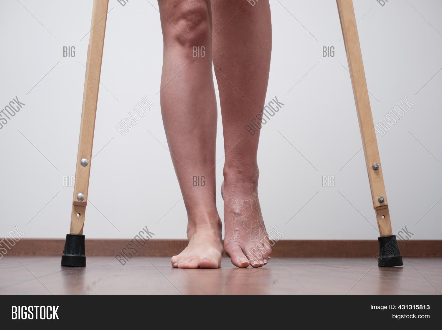 Woman After Broken Leg Image & Photo (Free Trial) | Bigstock
