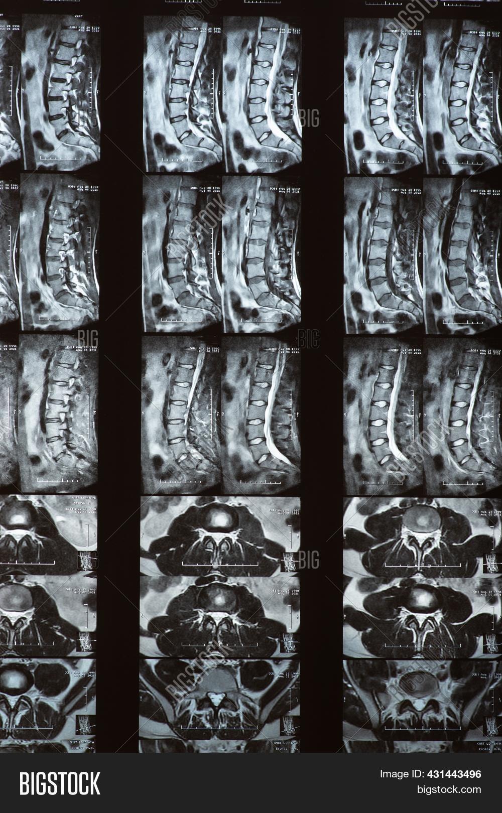 X-ray Spine. Medical Image & Photo (Free Trial) | Bigstock