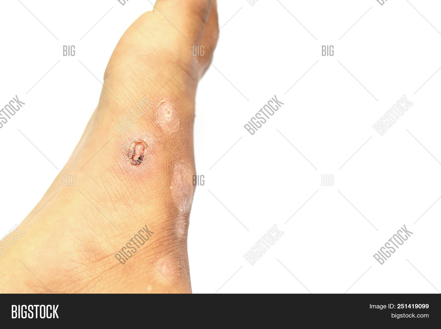 Foot Child Wound Image & Photo (Free Trial) | Bigstock