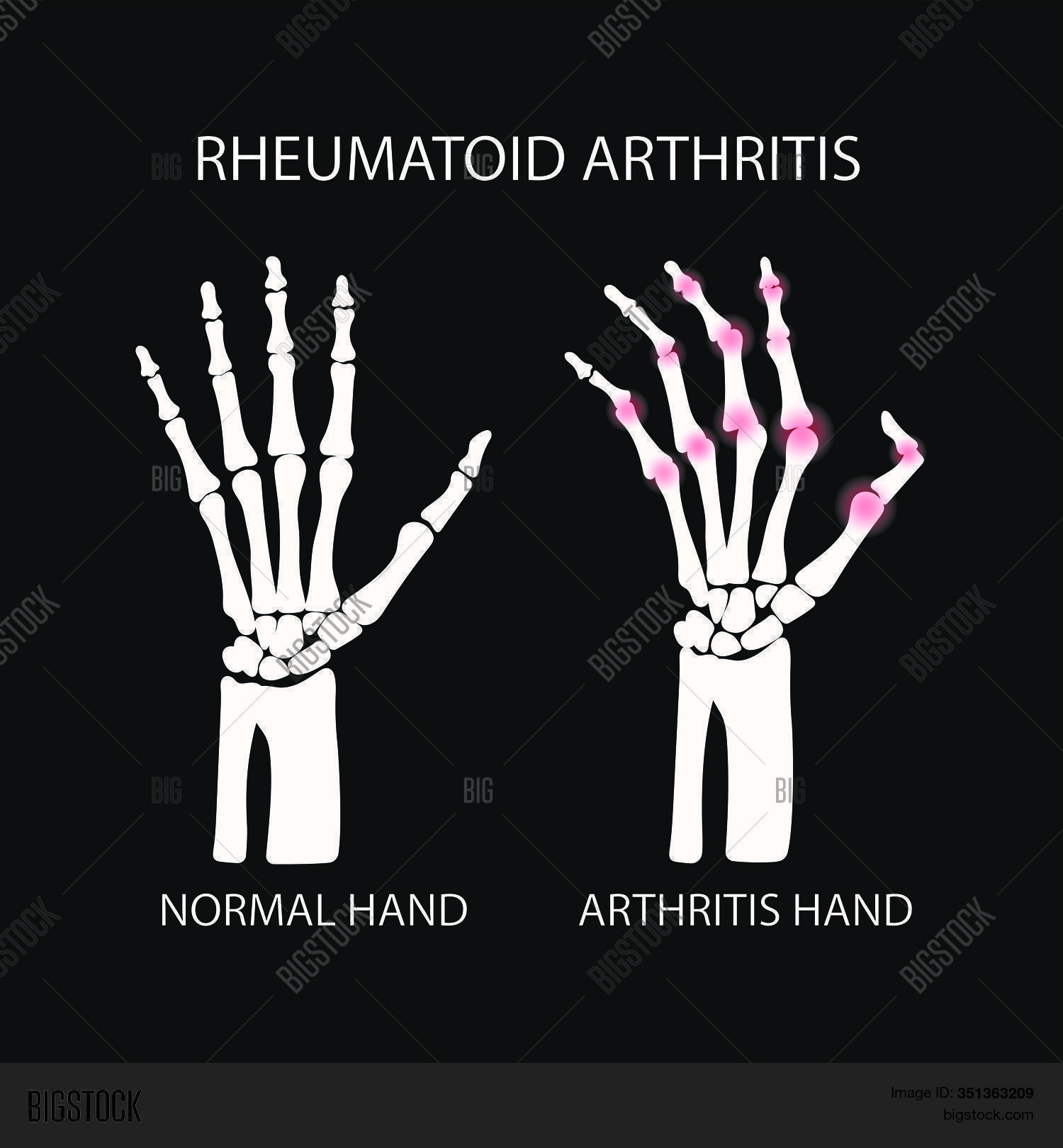 Rheumatoid Artritis Vector & Photo (Free Trial) | Bigstock