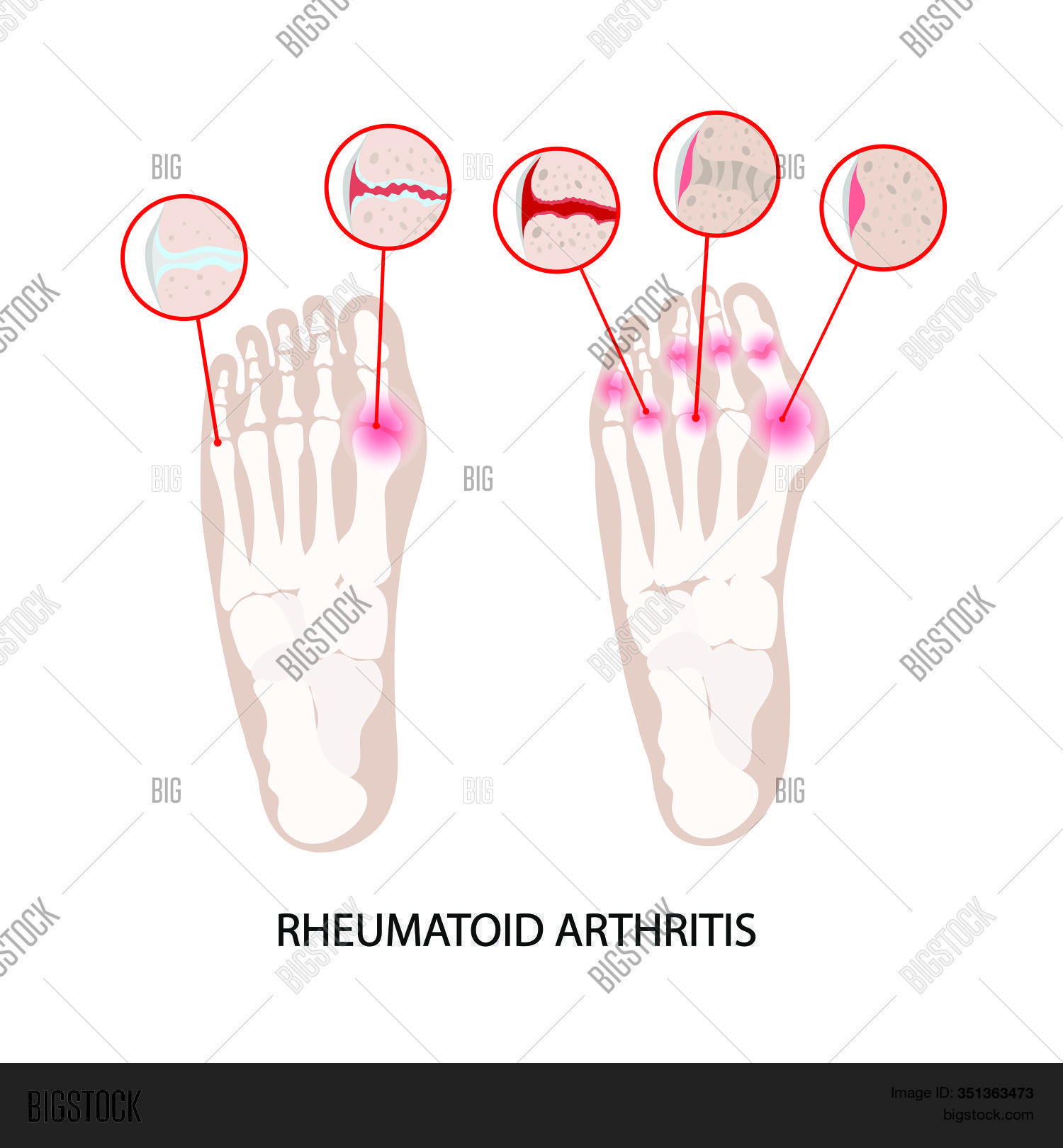 Rheumatoid Disease Vector & Photo (Free Trial) | Bigstock