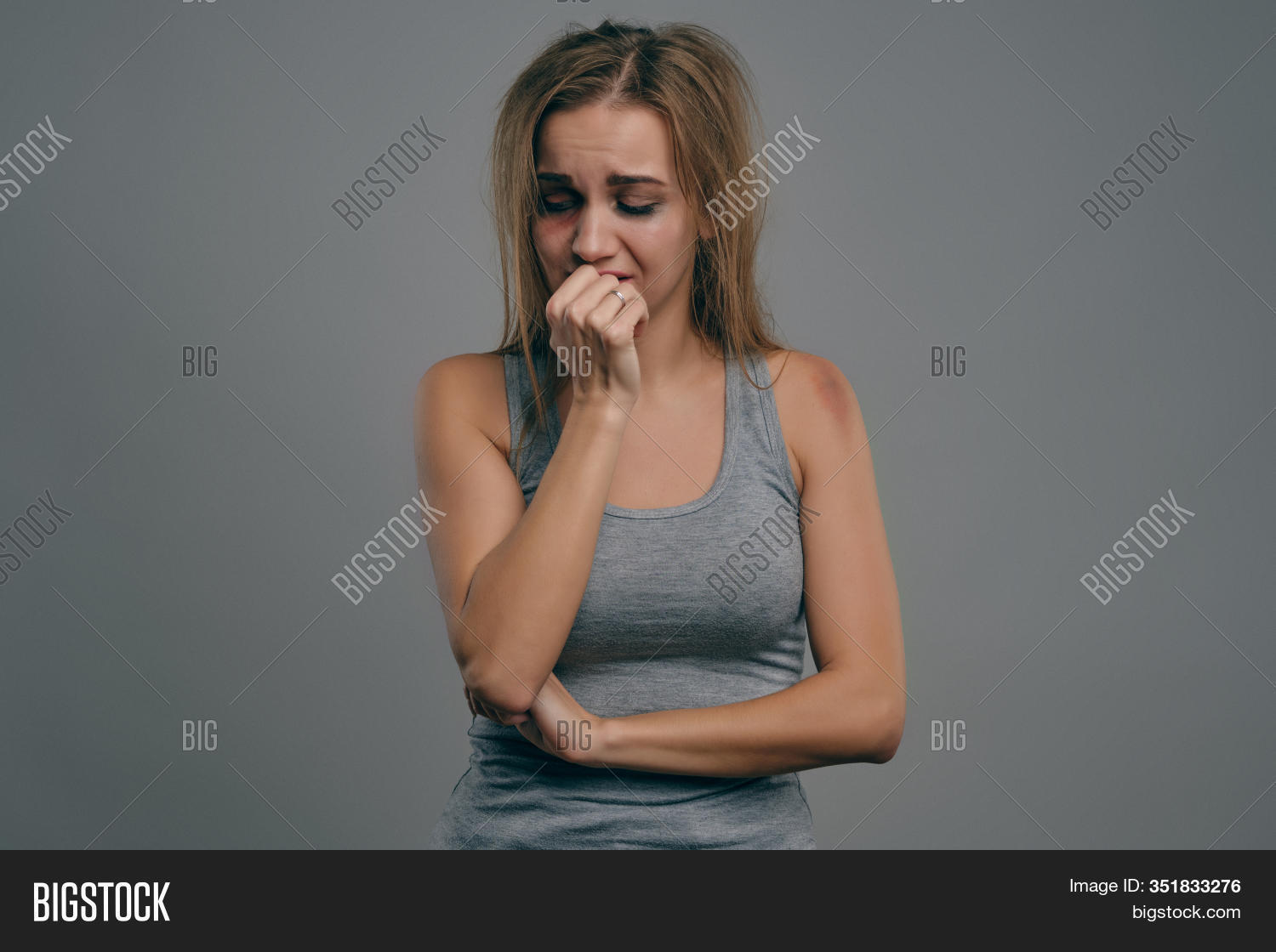 Blonde Girl Bruises On Image & Photo (Free Trial) | Bigstock