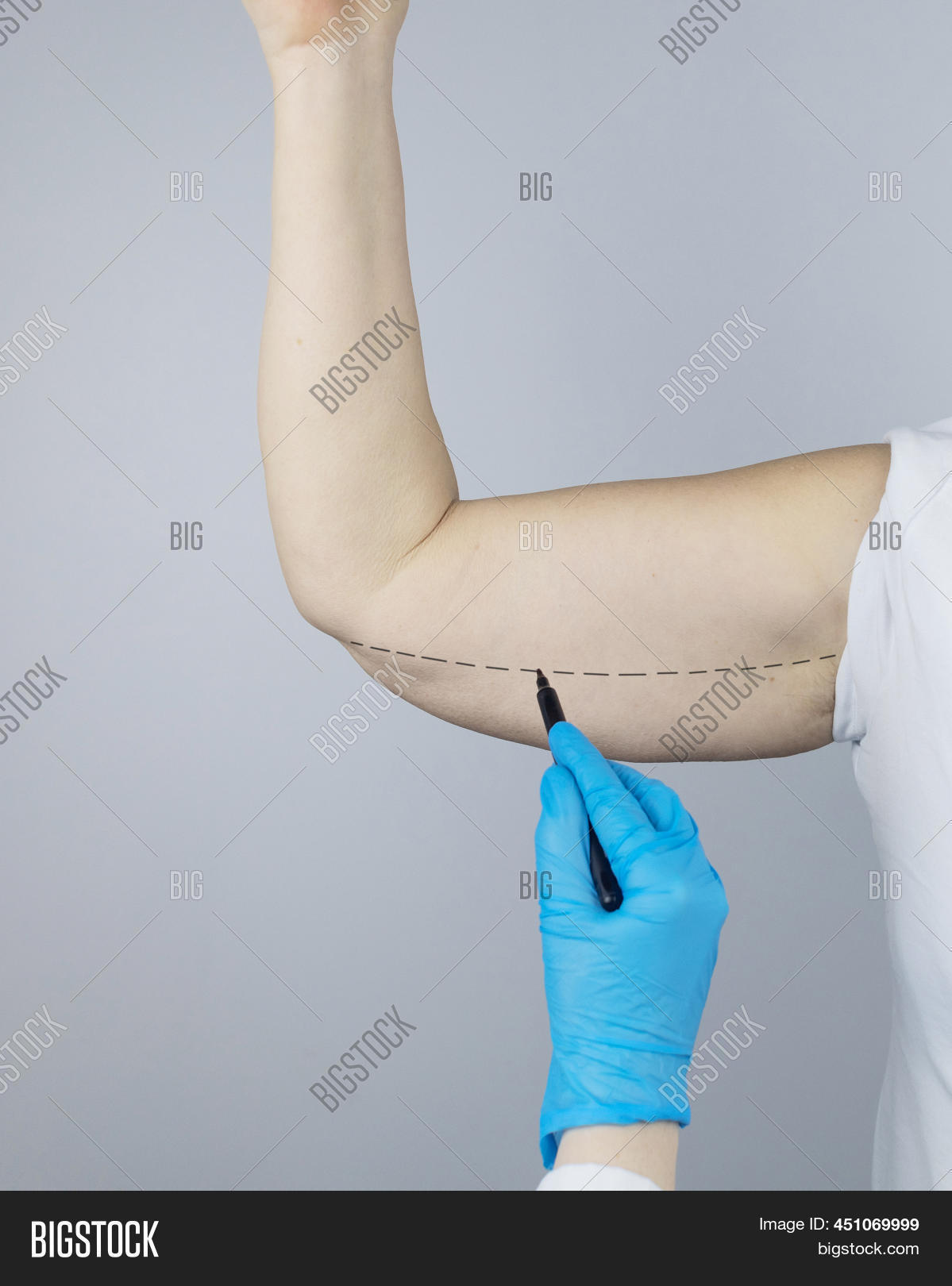 Brachioplasty. Plastic Image & Photo (Free Trial) | Bigstock