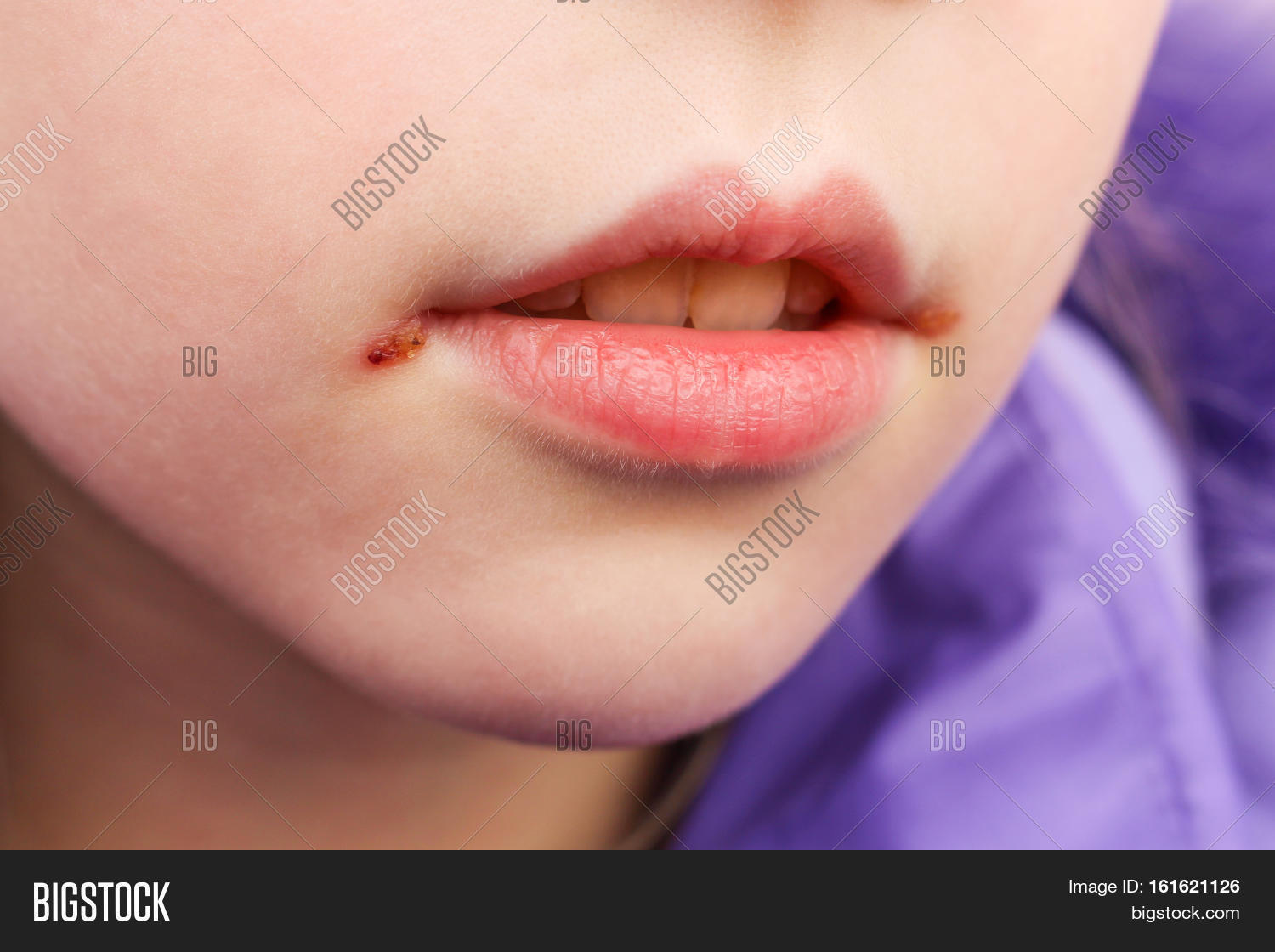 Close Herpes On Lips Image And Photo Free Trial Bigstock