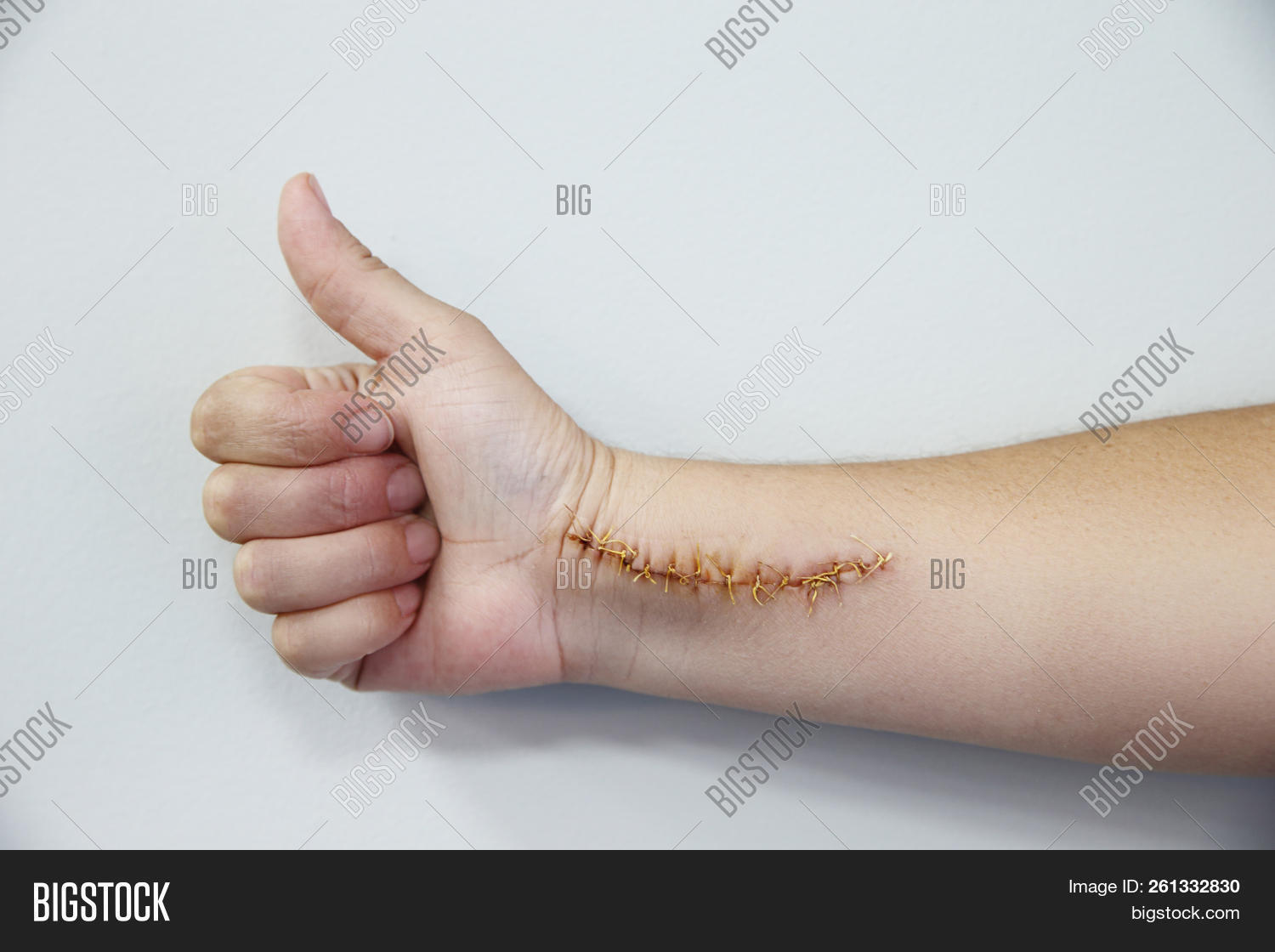 Humand Hand Hurt Big Image & Photo (Free Trial) | Bigstock