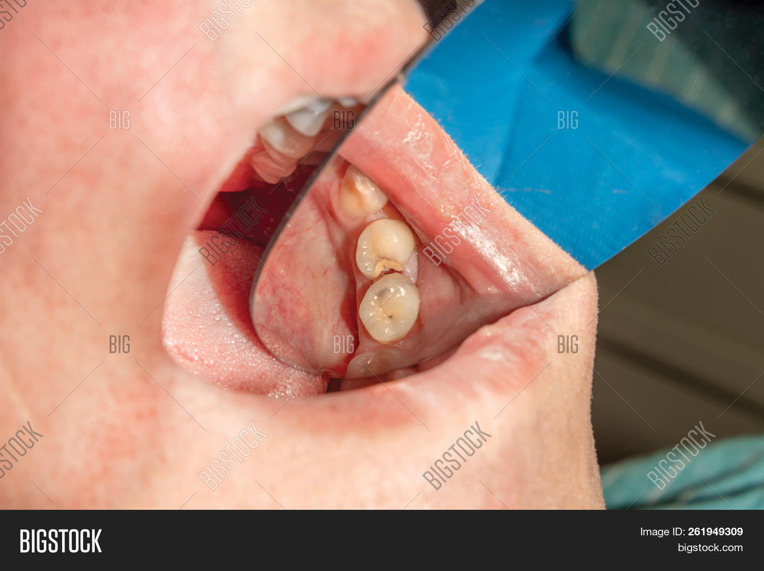 Restoration Molar Image & Photo (Free Trial) | Bigstock