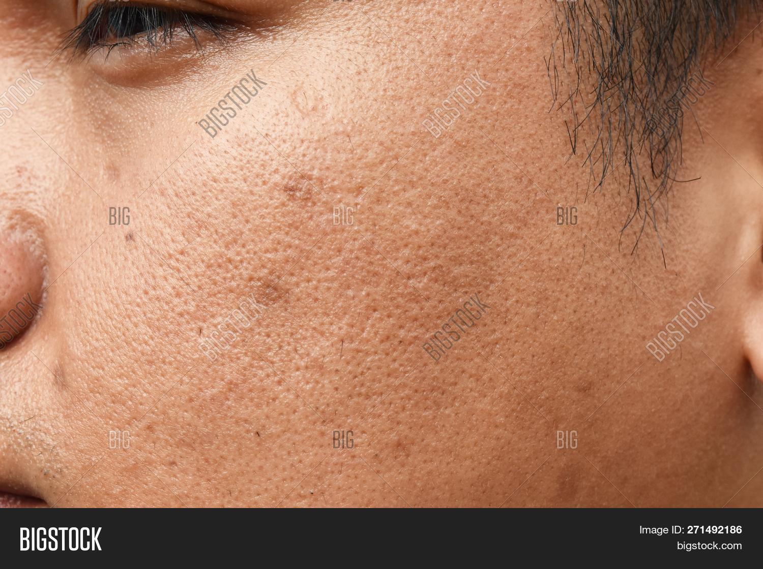 Pores Oily On Surface Image & Photo (Free Trial) | Bigstock