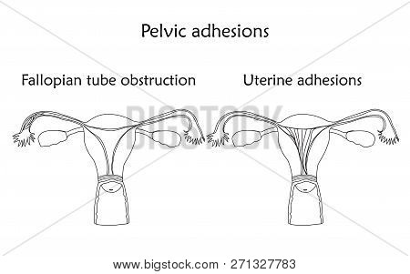Pelvic Adhersions. Vector & Photo (Free Trial) | Bigstock