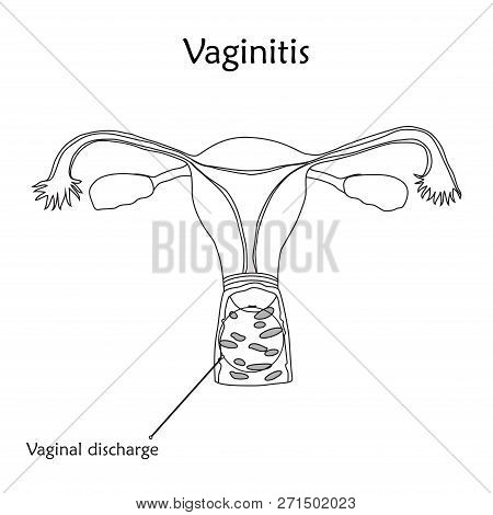 Vaginitis. Human Vector & Photo (Free Trial) | Bigstock