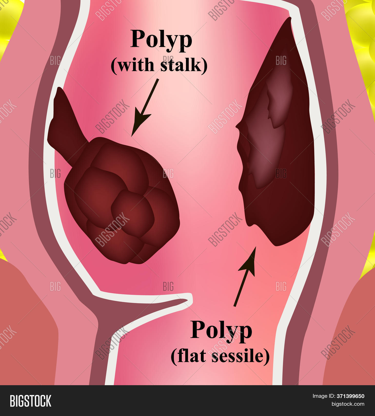 Polyps Rectum. Image & Photo (Free Trial) | Bigstock