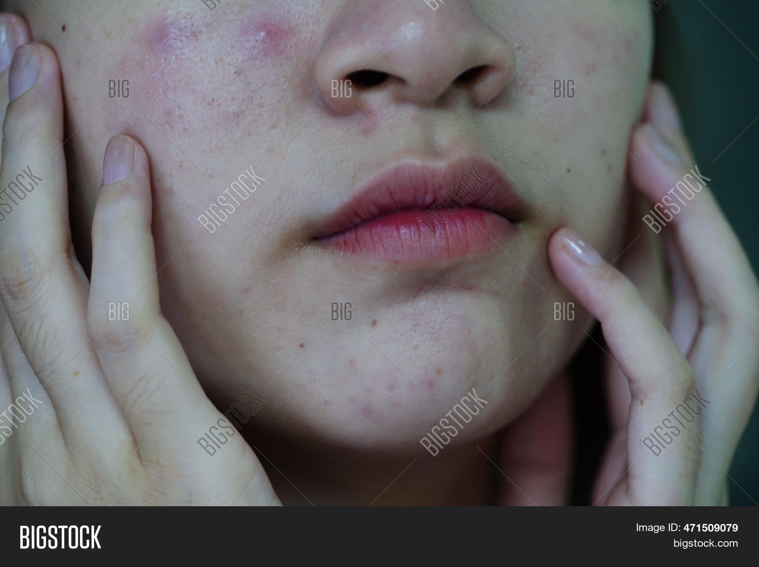 Acne Pimple Scar On Image & Photo (Free Trial) | Bigstock