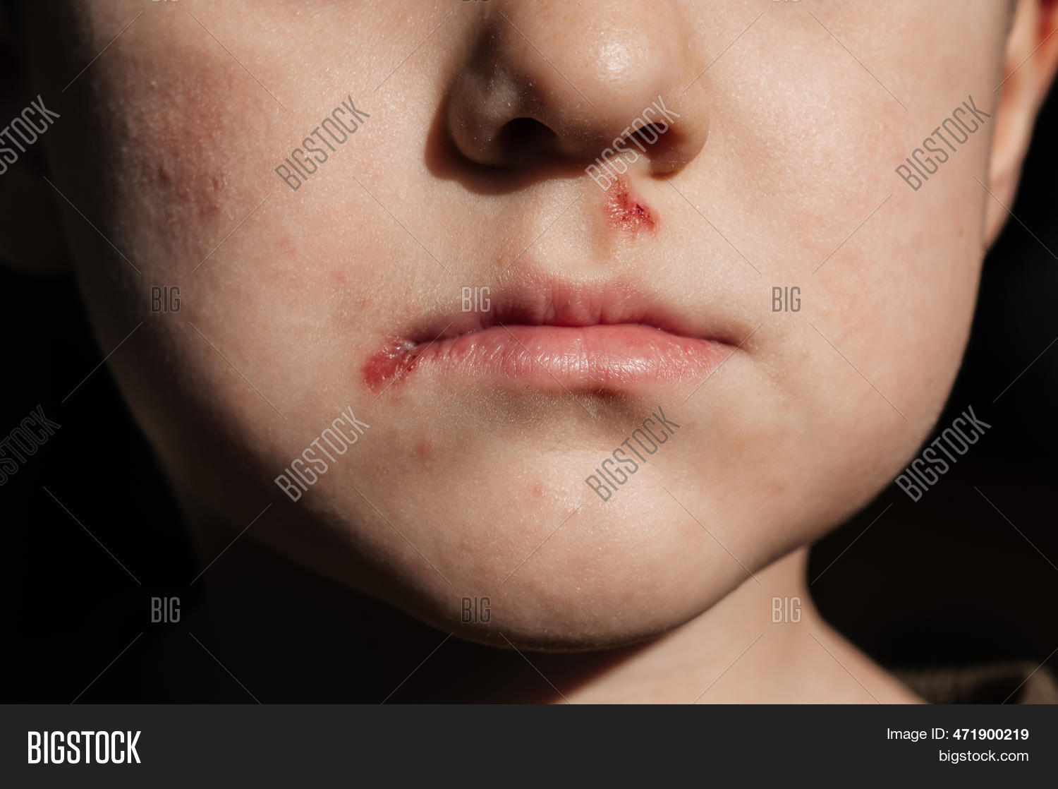 Boy Sores On His Face Image & Photo (Free Trial) | Bigstock