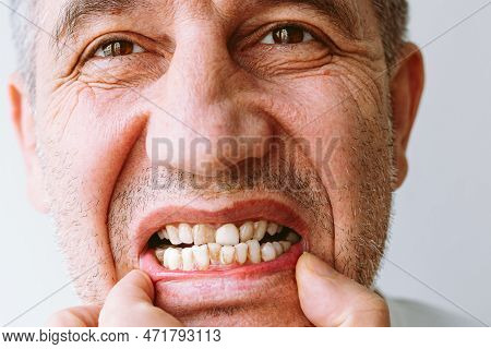 Teeth Tartar, Plaque. Image & Photo (Free Trial) | Bigstock