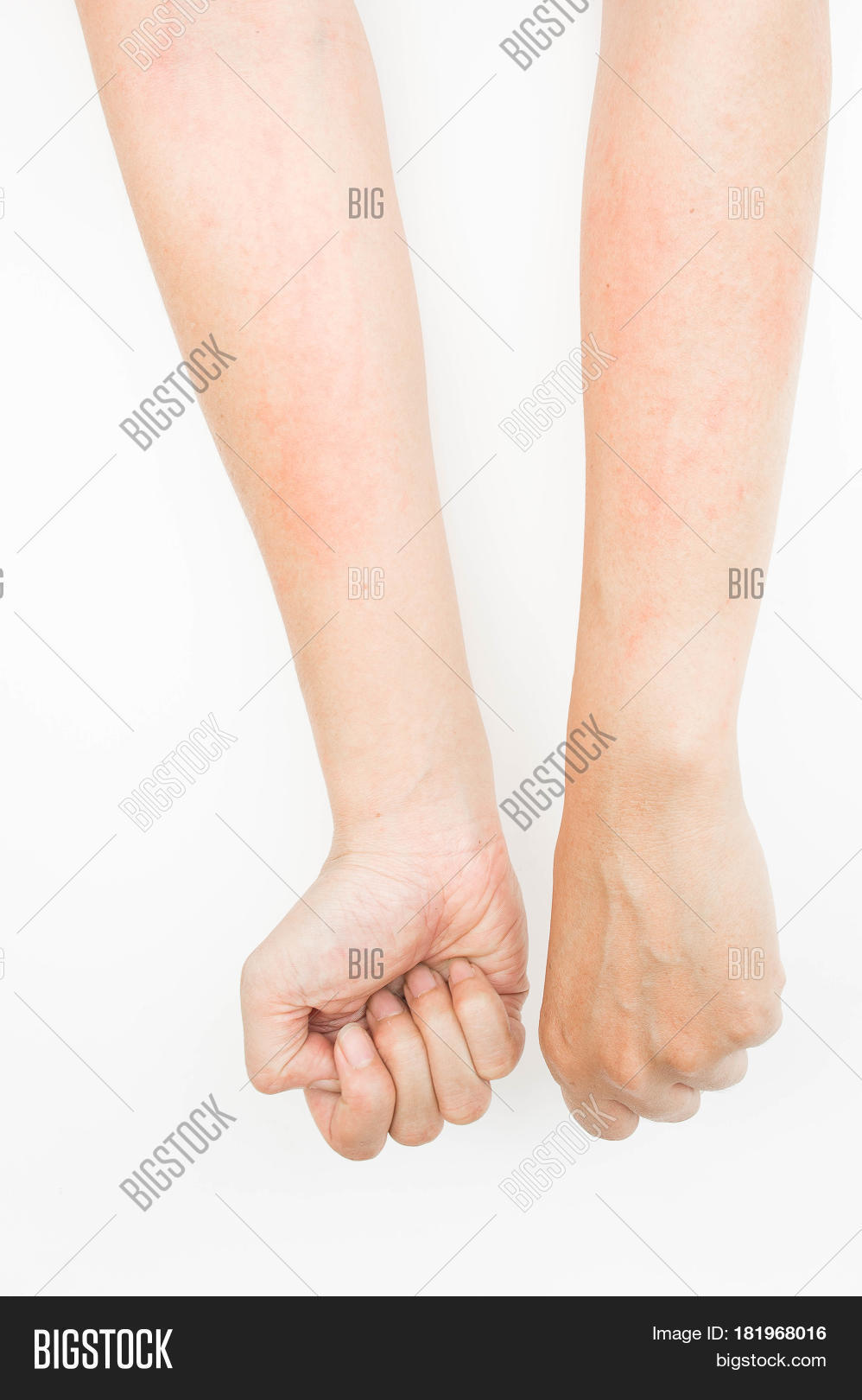 Rash Allergy Touching Image & Photo (Free Trial) | Bigstock