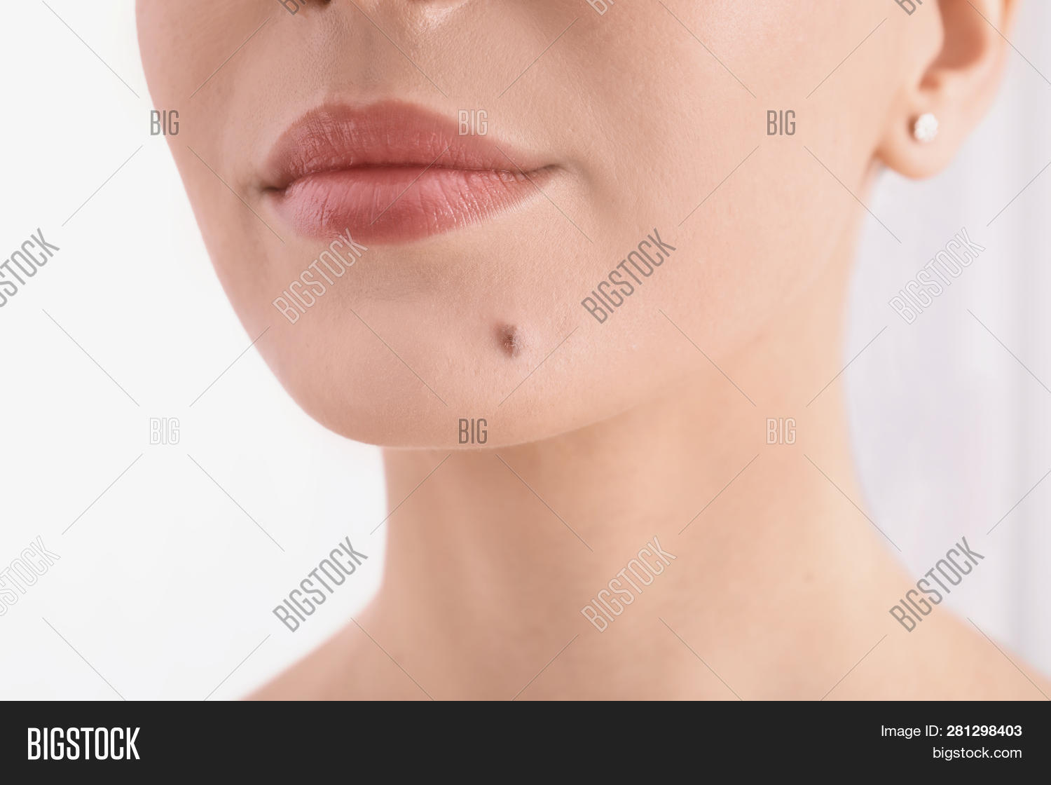 Young Woman Birthmark Image & Photo (Free Trial) | Bigstock