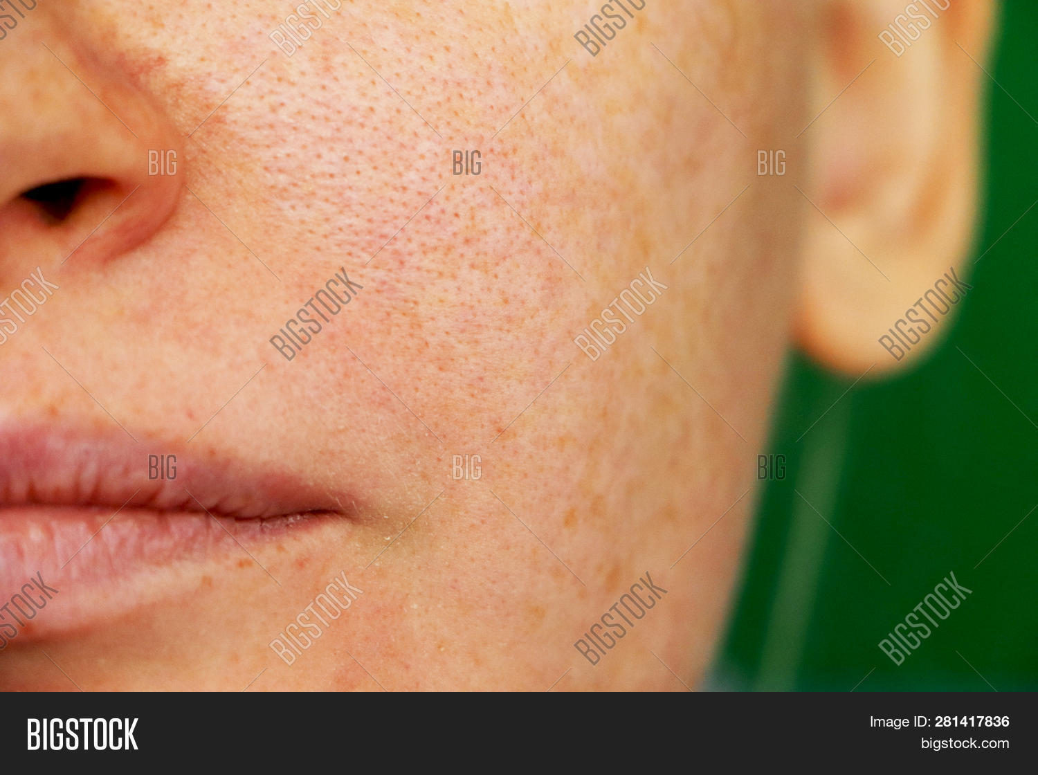 Freckles, Pigmentation Image & Photo (Free Trial) | Bigstock