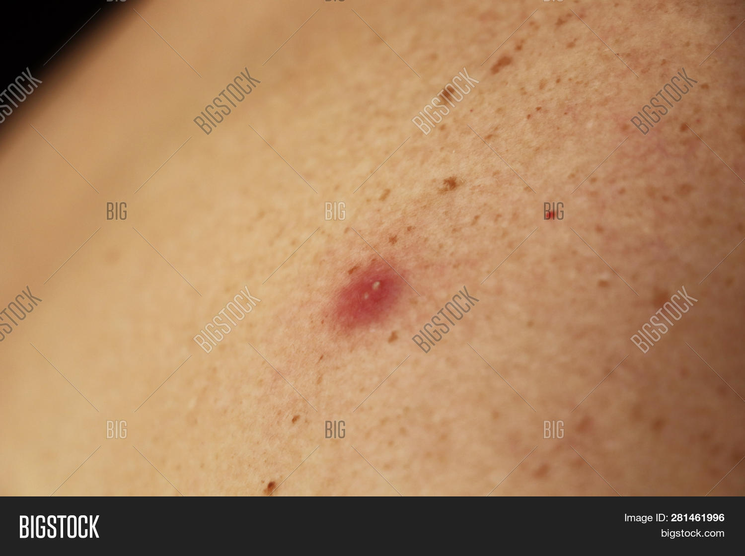 Photo Pimple Pus On Image & Photo (Free Trial) | Bigstock