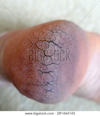 Human Heel Crack, Foot Image & Photo (Free Trial) | Bigstock