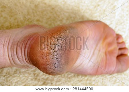 Human Heel Crack, Foot Image & Photo (Free Trial) | Bigstock