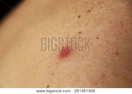 Photo Pimple Pus On Image & Photo (Free Trial) | Bigstock