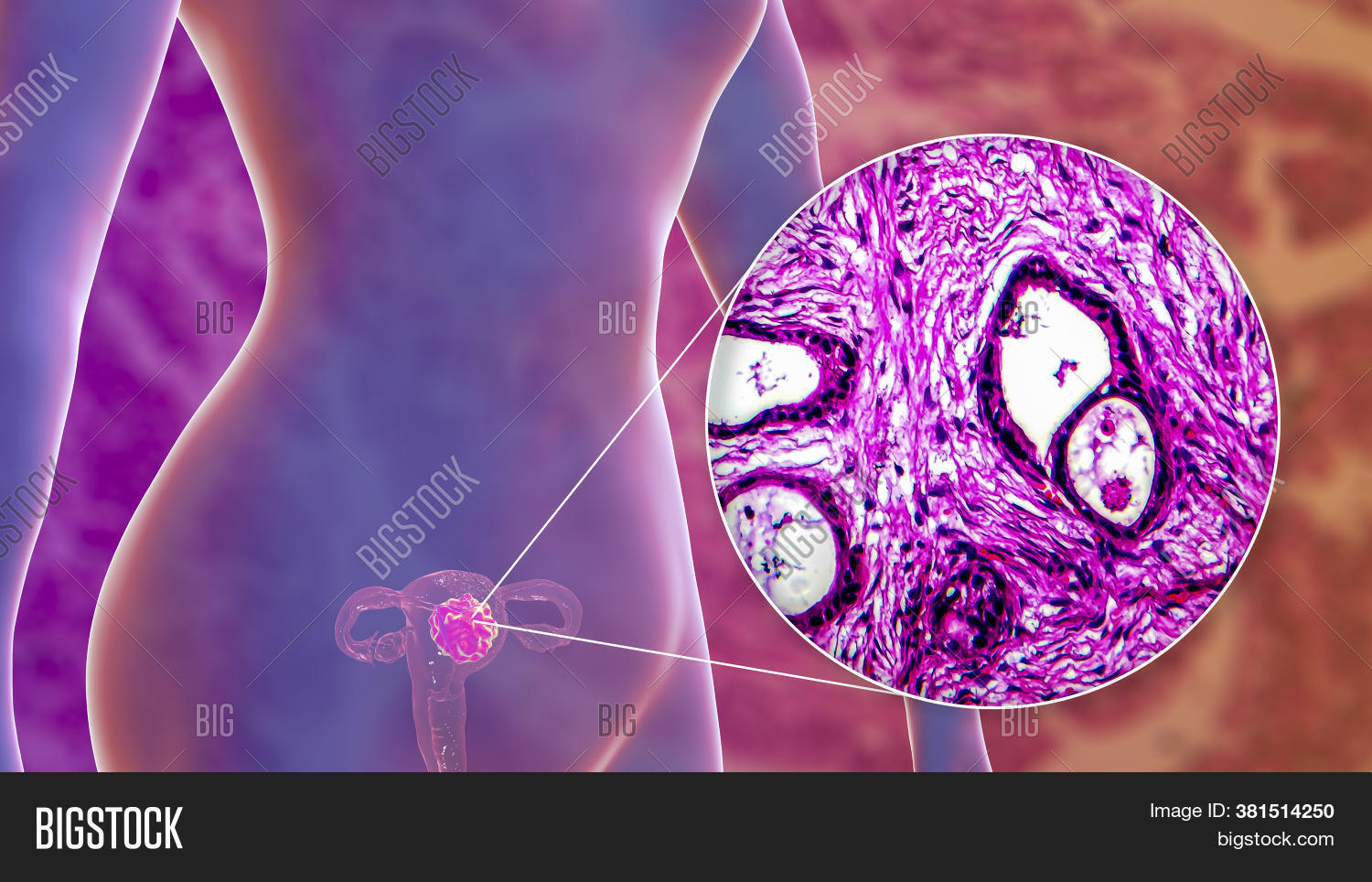 Uterine Cancer, 3d Image & Photo (Free Trial) | Bigstock