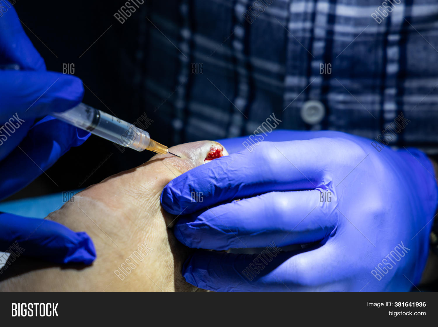 Series Ingrown Toenail Image & Photo (Free Trial) | Bigstock