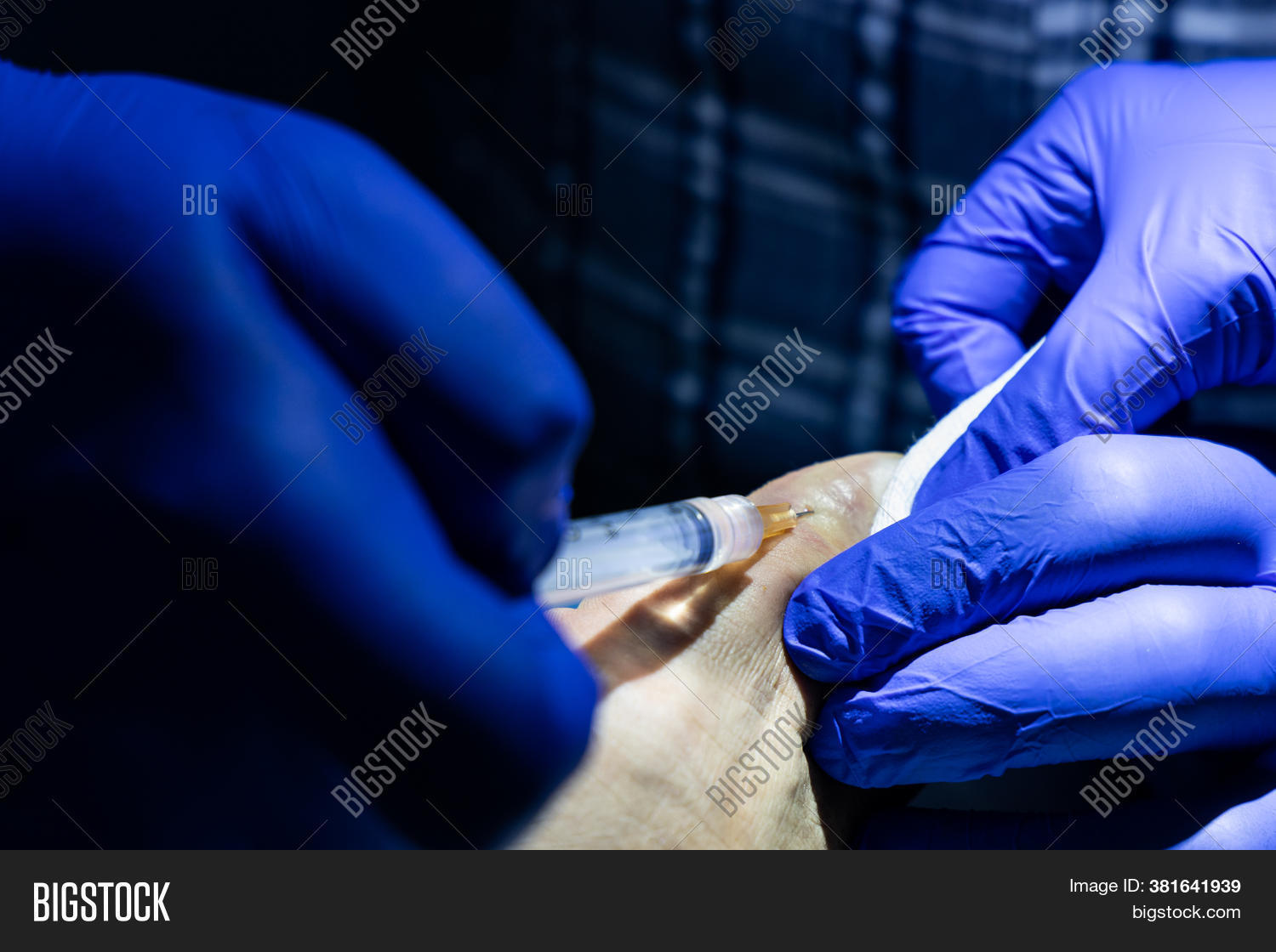 Series Ingrown Toenail Image & Photo (Free Trial) | Bigstock
